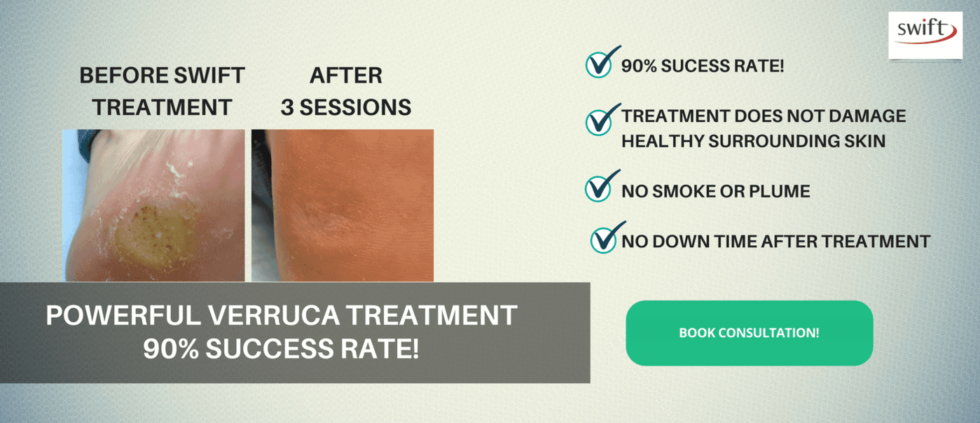 Verruca Treatment Options | Swift, Needling, Verrutop & Cryotherapy